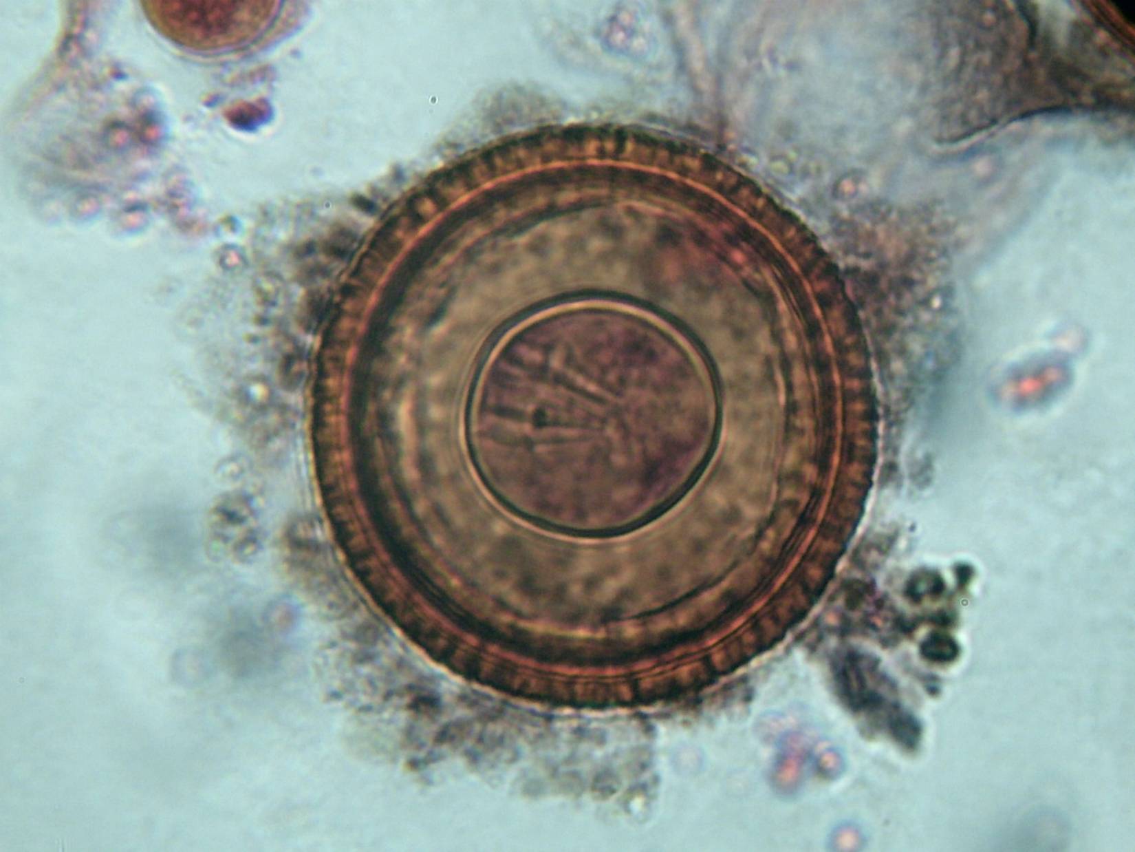 Worms Can Live In Your Brain Without You Knowing (& Here's How To ...